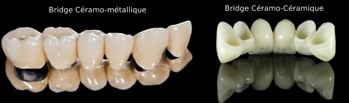 Bridge Dentaire | Dentiste Marrakech | Mb Dental